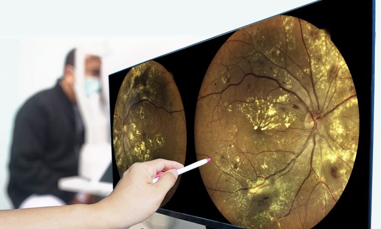 Diabetic Retinopathy - Aspect Eye Surgeons