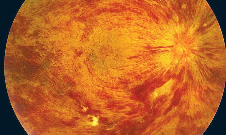 Retinal Vascular Disease - Aspect Eye Surgeons